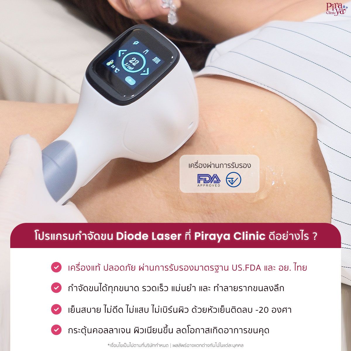 Diode Laser กำจัดขน ทำลายรากลึก | Piraya Clinic เมืองทอง